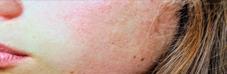 My Acupuncturist Tells Me I Am "Damp"! - My Complete Balance